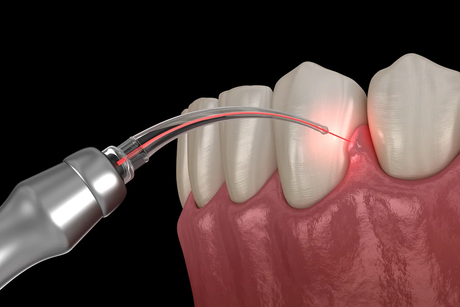 Soft Tissue Laser Therapy Gentle Treatment For Gum Disease And